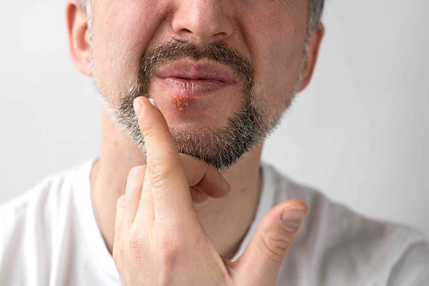 Causas y tratamiento de las boqueras